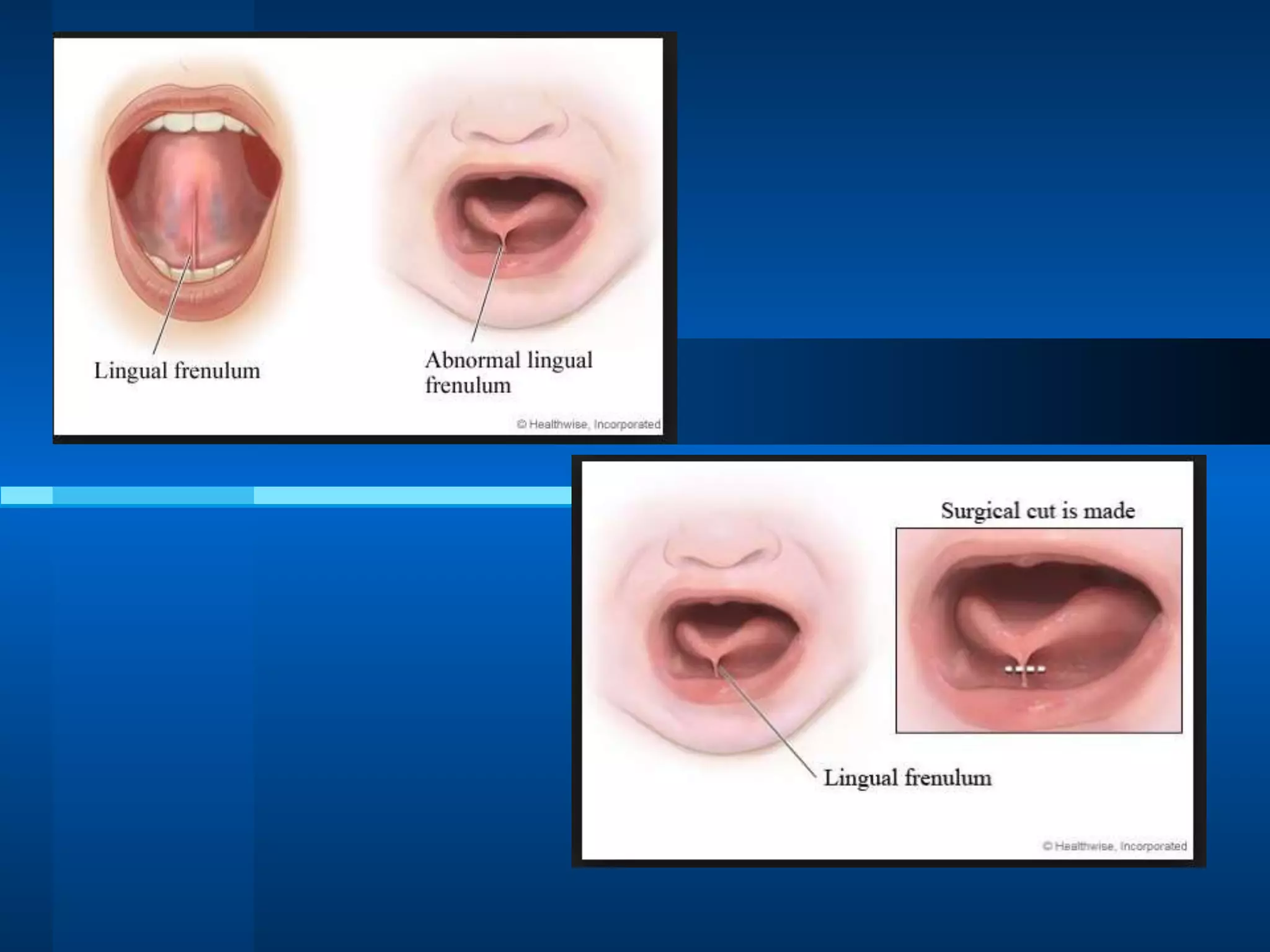 Disorders of tongue, lips, salaivary glands and teeth | PDF