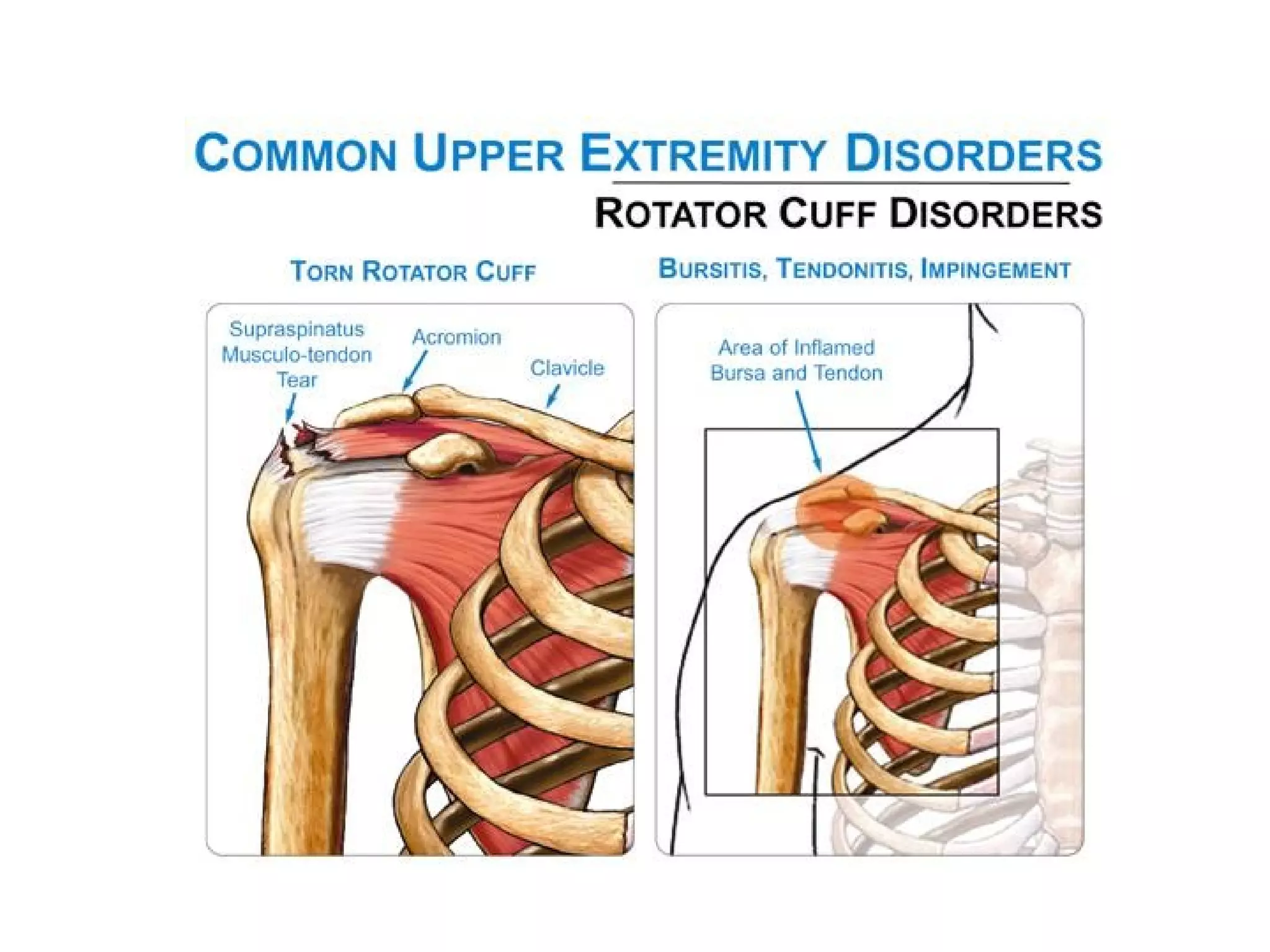 Disorders of upper limb | ODP