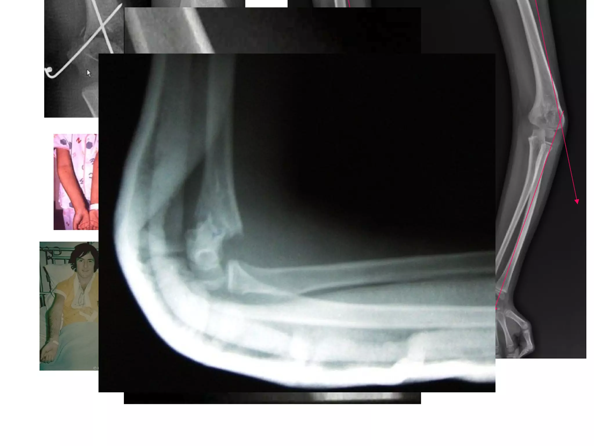 Disorders of upper limb | ODP