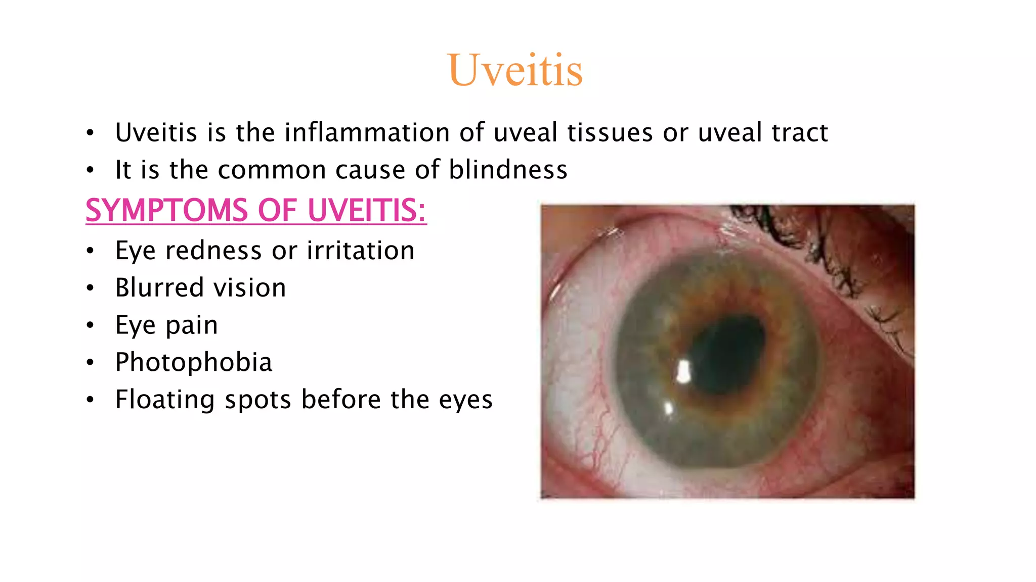 Disorders of uveal tract | PPTX
