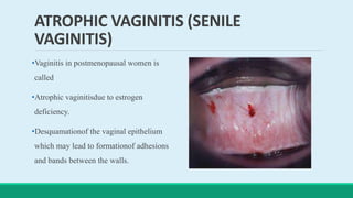 Disorders of vagina | PPT