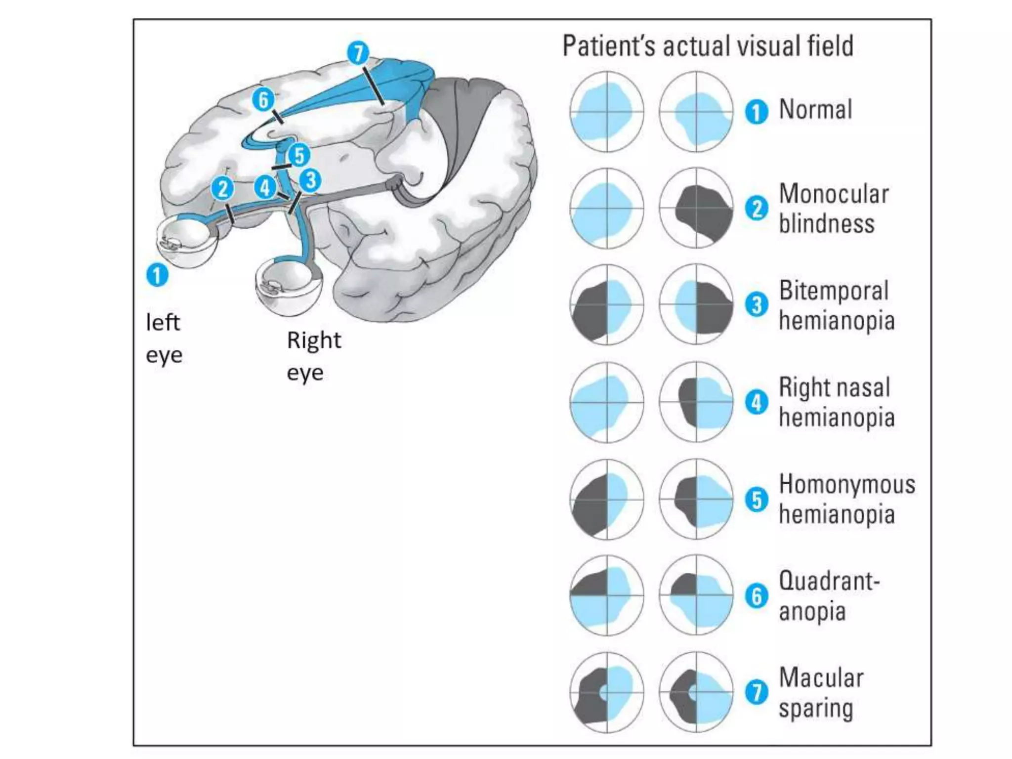 Disorders of visual pathway | PPTX