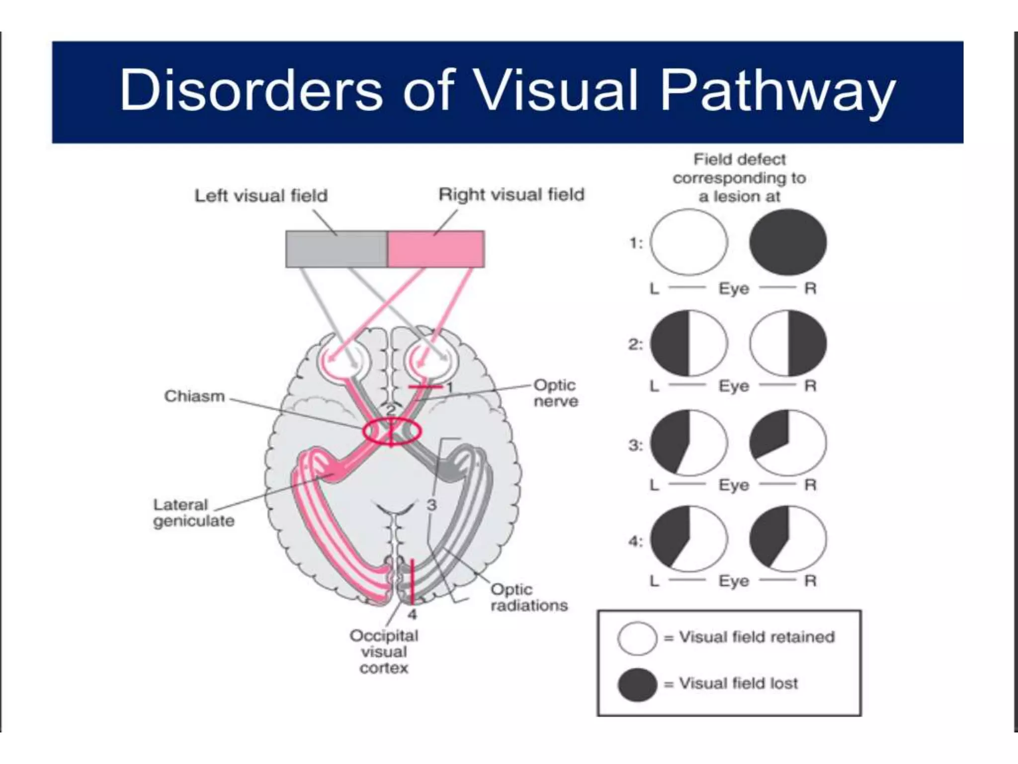 Disorders of visual pathway | PPTX