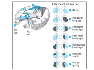 Disorders of visual pathway | PPTX