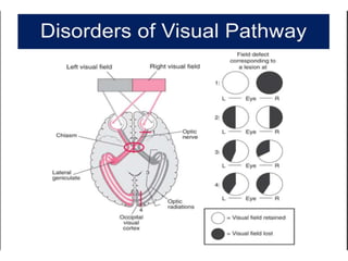Disorders of visual pathway | PPTX