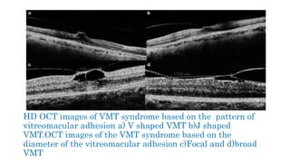 Disorders of vitreomacular interface by dr navid | PPTX