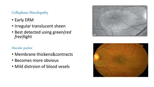 Disorders of vitreomacular interface by dr navid | PPTX