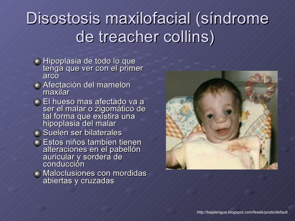 Disostosis Maxilofacial