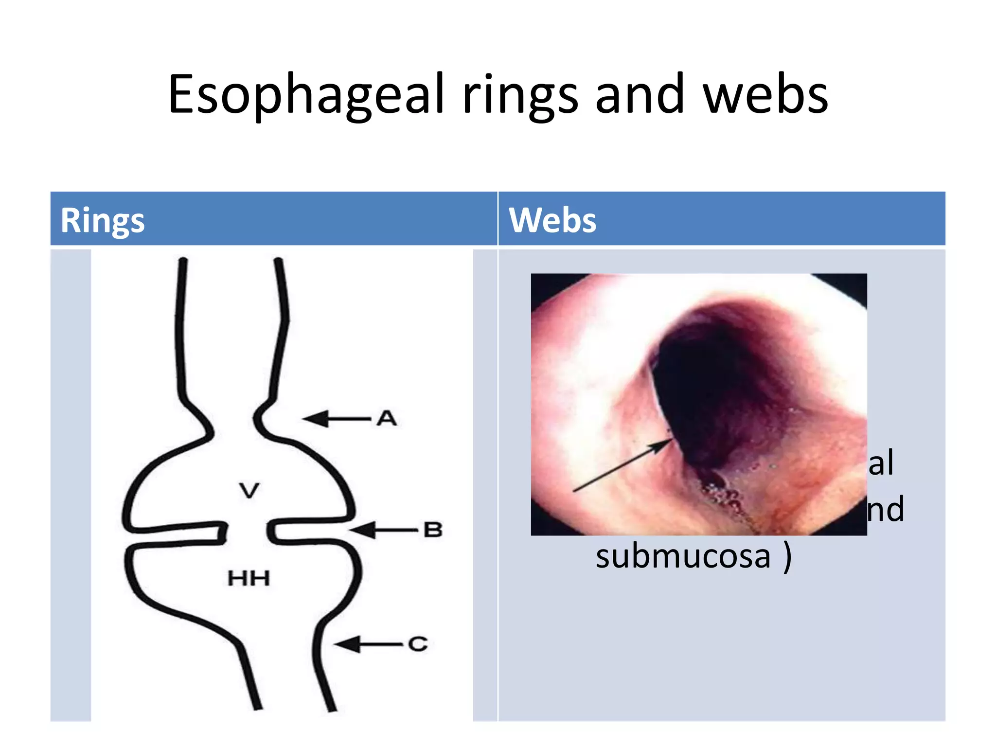 approach to Disphagia for medical students | PPTX