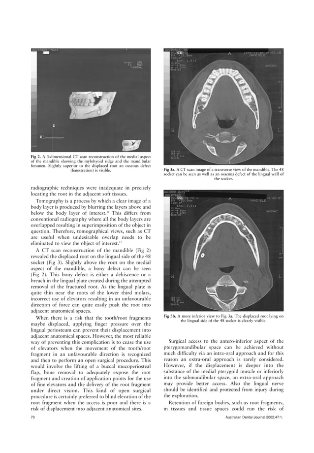 Displacement of a_mandibular_third_molar_root_fragment_into_the ...