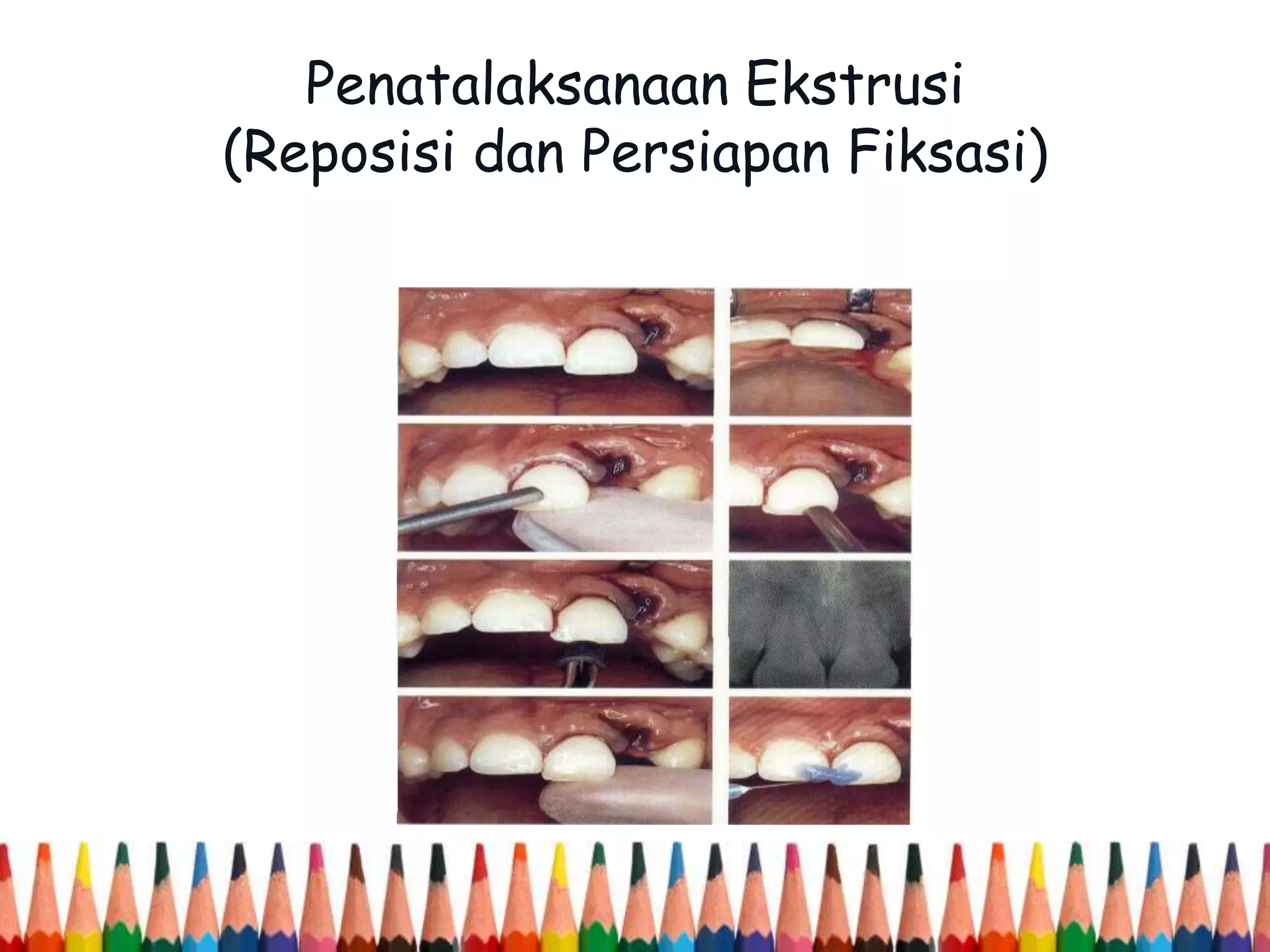 Displacement tooth (traumatic injury on children) | PPTX