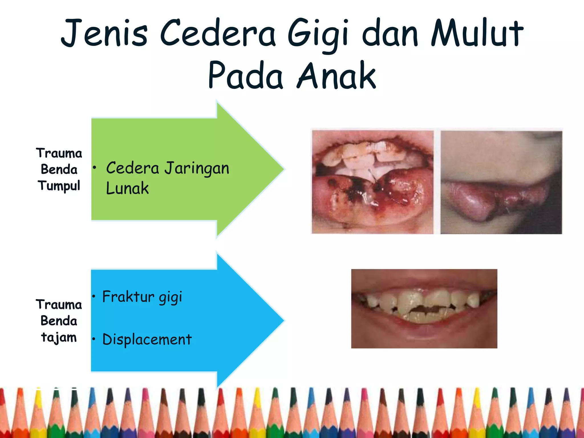 Displacement tooth (traumatic injury on children) | PPTX