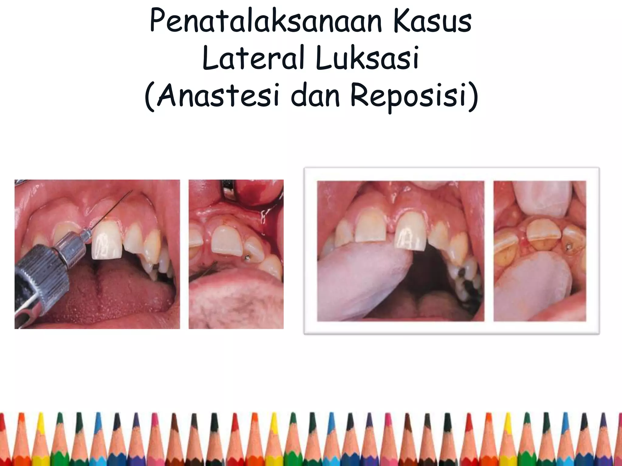 Displacement tooth (traumatic injury on children) | PPTX