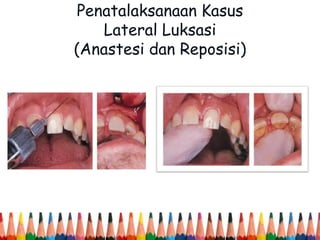 Displacement tooth (traumatic injury on children) | PPTX