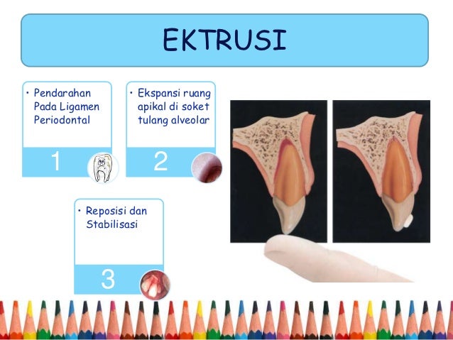 Displacement tooth (traumatic injury on children)