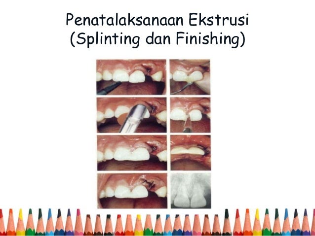 Displacement tooth (traumatic injury on children)