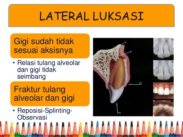 Displacement tooth (traumatic injury on children)