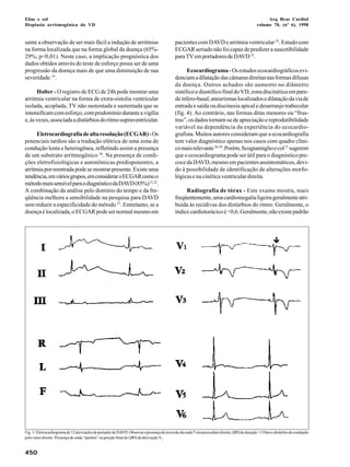 Displasia arritmogênica do ventrículo direito | PDF