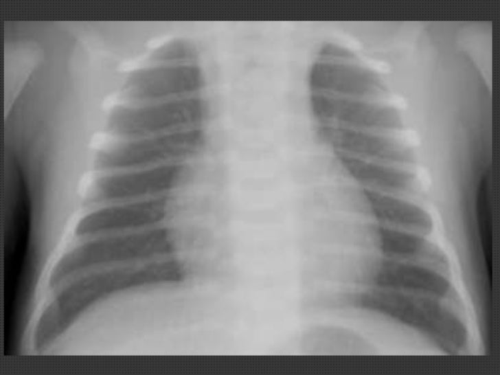 Displasia broncopulmonar