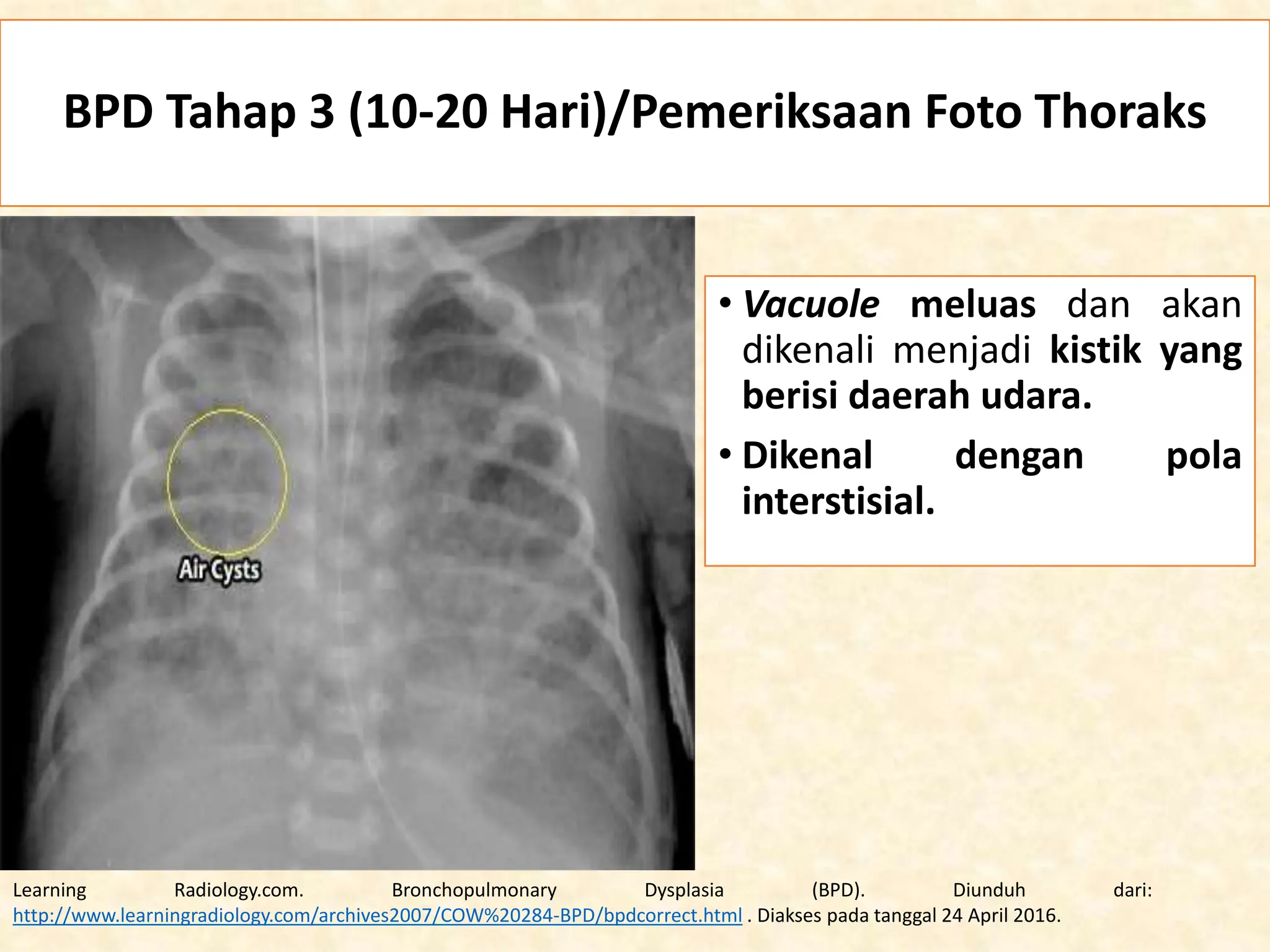 DISPLASIA_BRONKOPULMONER_FIX1_Perawati.pptx