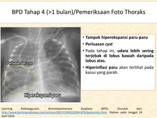 DISPLASIA_BRONKOPULMONER_FIX1_Perawati.pptx