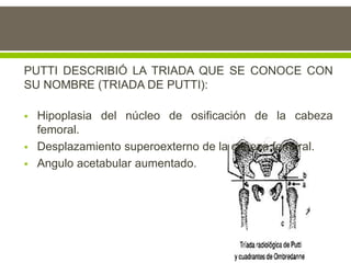 DISPLASIA DEL DESARROLLO DE LA CADERA | PPTX