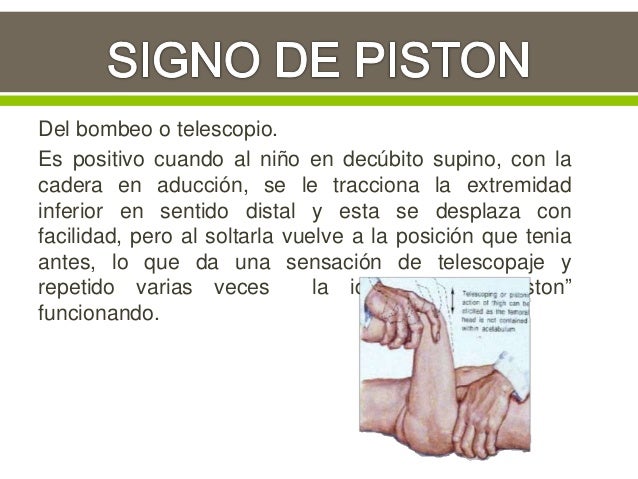 Displasia Del Desarrollo De La Cadera