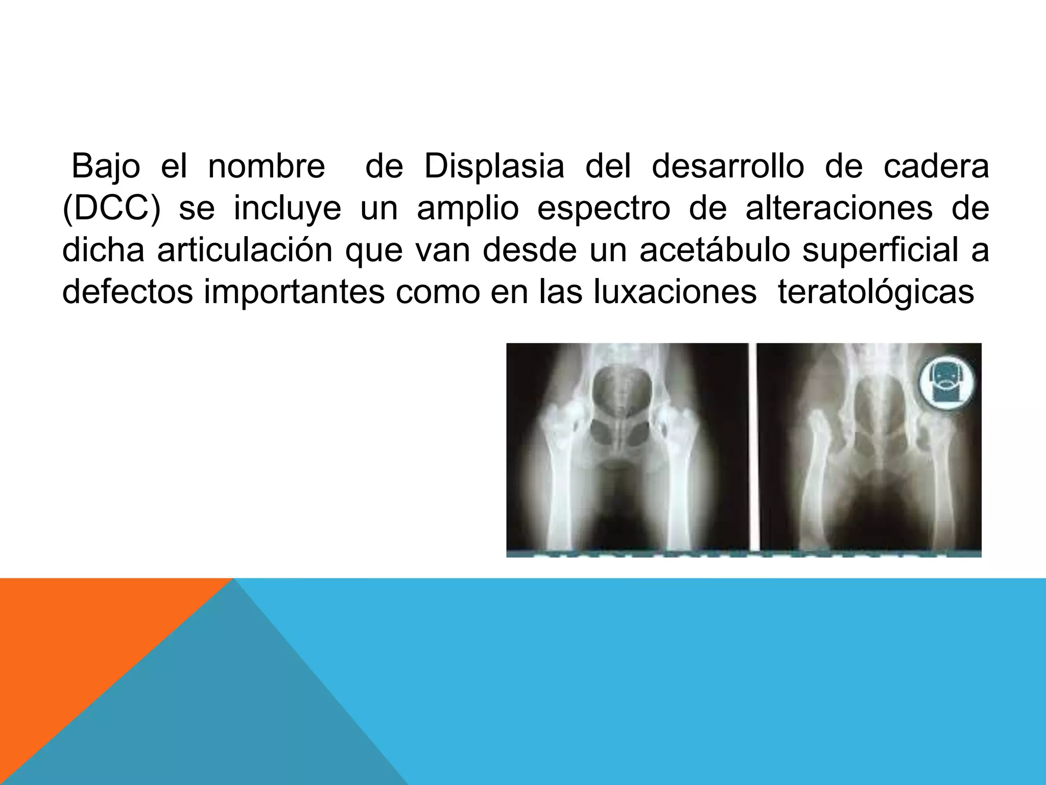 Displasia de cadera | PPT