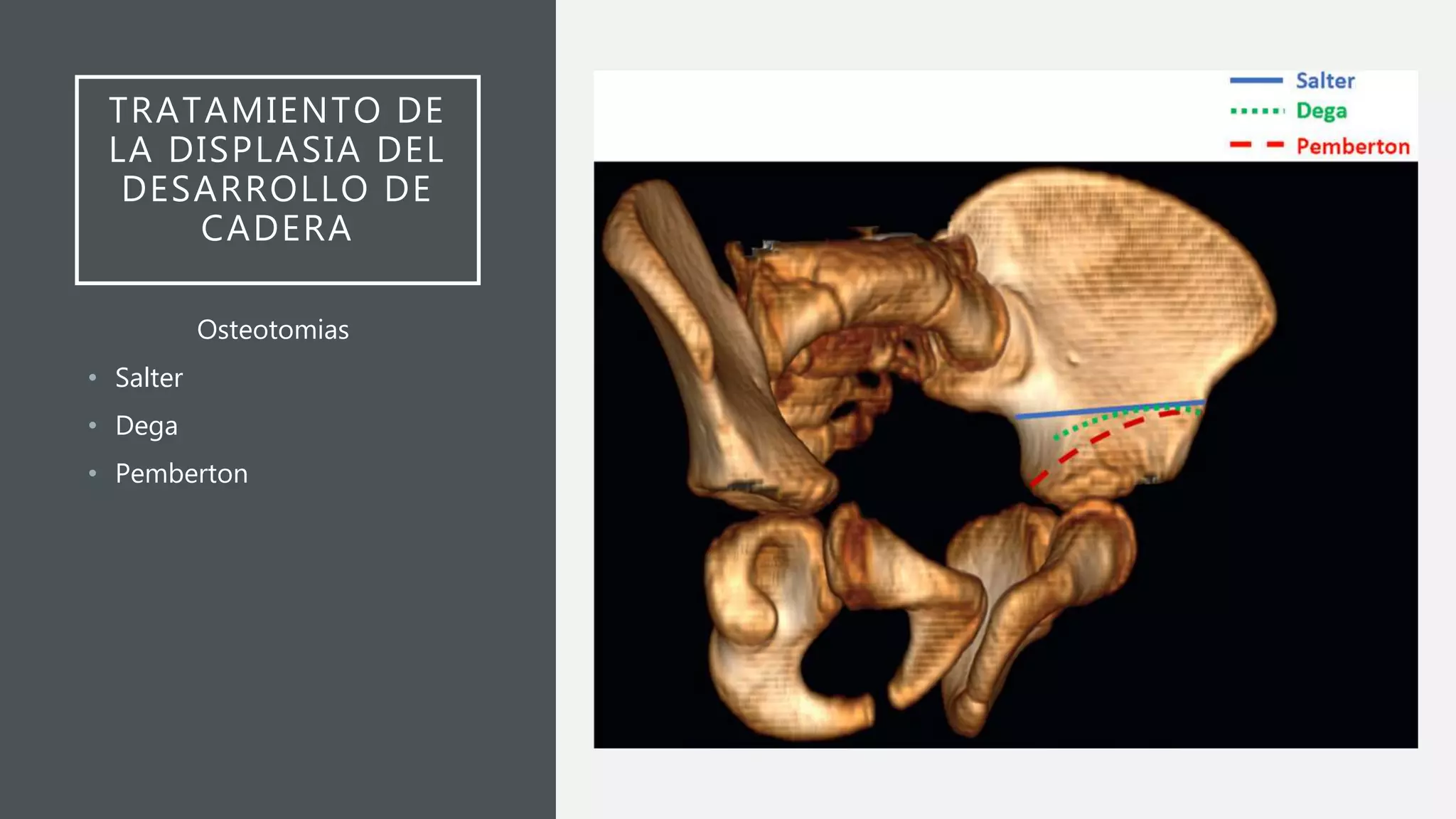 Displasia de cadera | PPTX