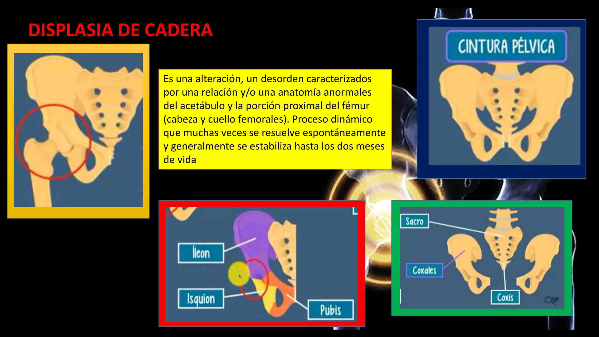 Displasia de cadera | PPT