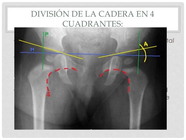 Displasia de la cadera en desarrollo