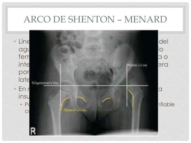 Displasia de la cadera en desarrollo