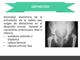 Displasia del desarrollo de cadera, Genu Varo, Valgum | PPTX