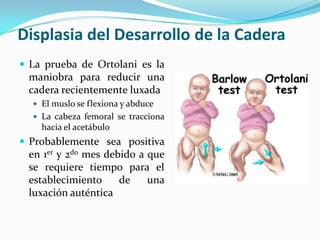 CPHAP 018 Displasia del Desarrollo de la Cadera | PPTX