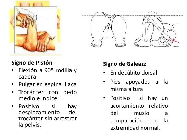 Displasia En El Desarrollo De Cadera