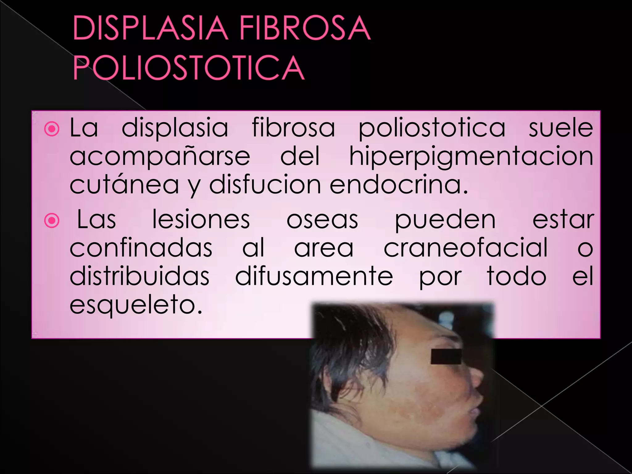 Displasia fibrosa | PPTX