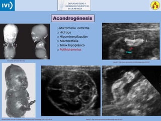 displasia osea esqueletica nomenclatura casos | PDF