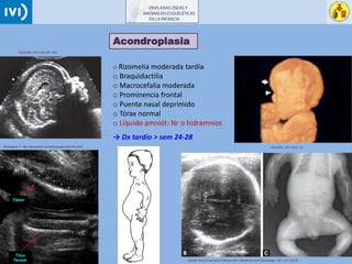 displasia osea esqueletica nomenclatura casos | PDF