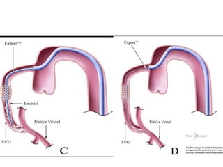 Dispositivos de proteção distal | PPTX