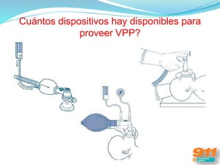 Dispositivos de vpp y compresiones | PPTX