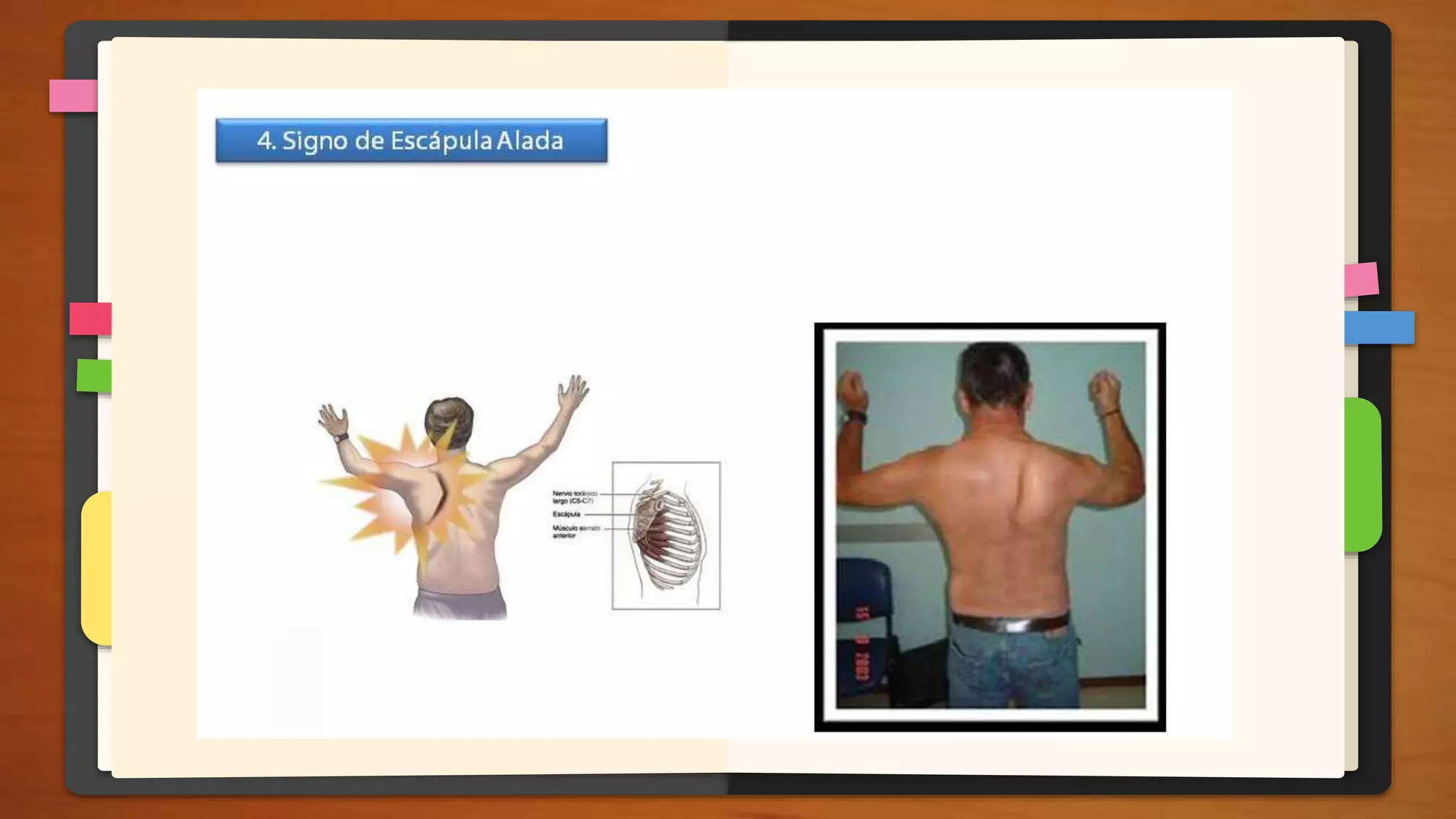 DISQUINECIA ESCAPULAR.pptx