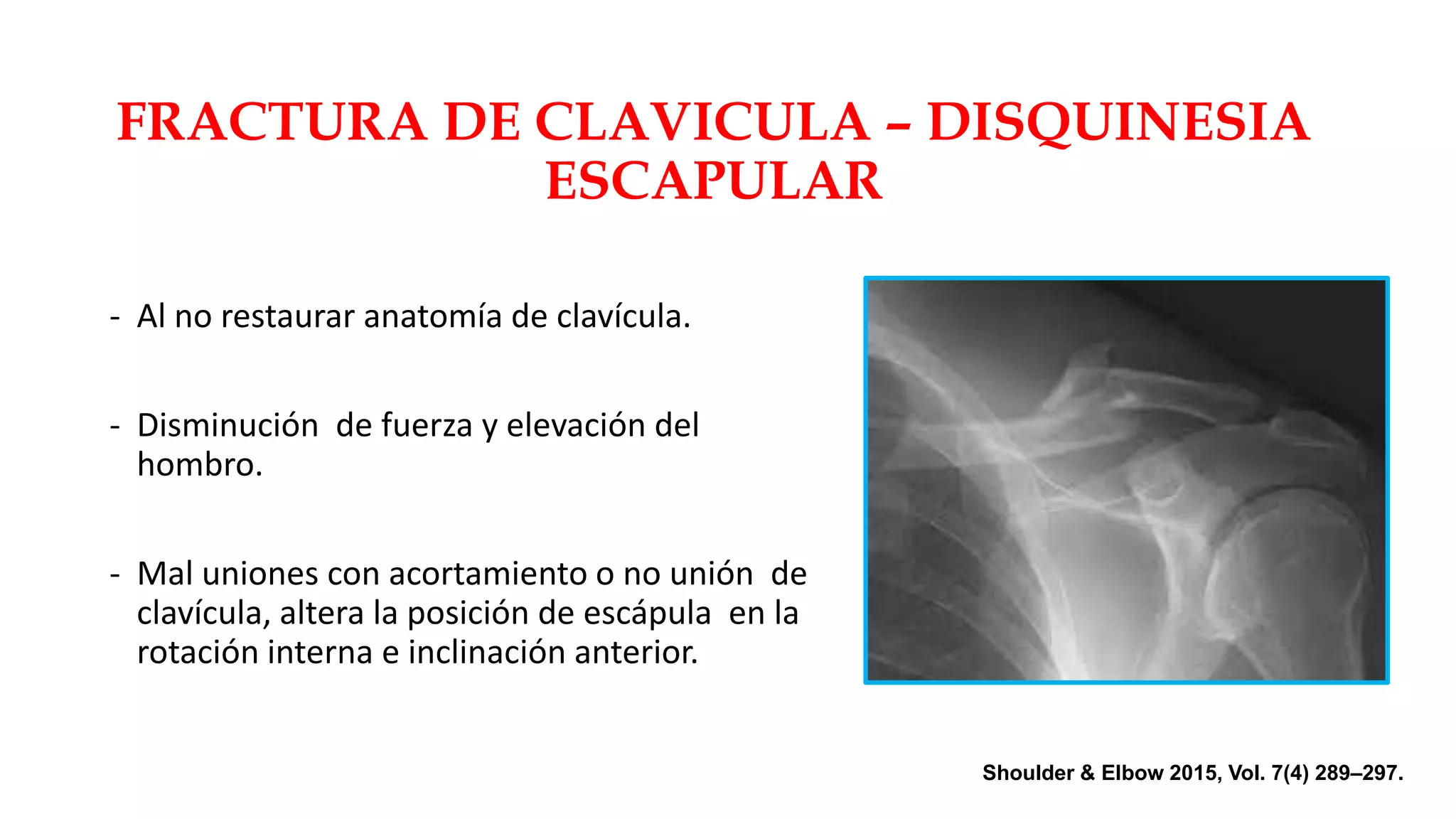 Disquinesia escapular post fractura clavicular | PPTX