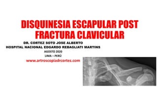 Disquinesia escapular post fractura clavicular | PPTX