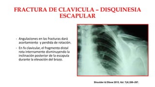 Disquinesia escapular post fractura clavicular | PPTX
