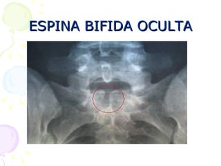 Espina Bífida Oculta Rayos X