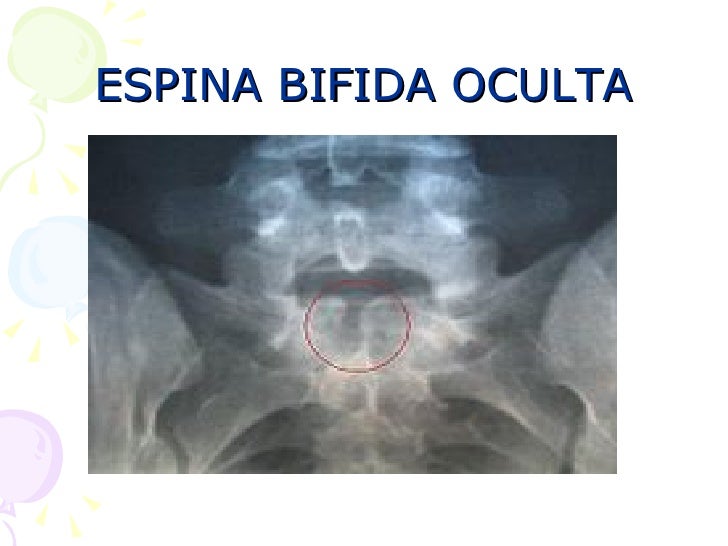 ESPINA BIFIDA OCULTA DIAGNOSTICO PDF