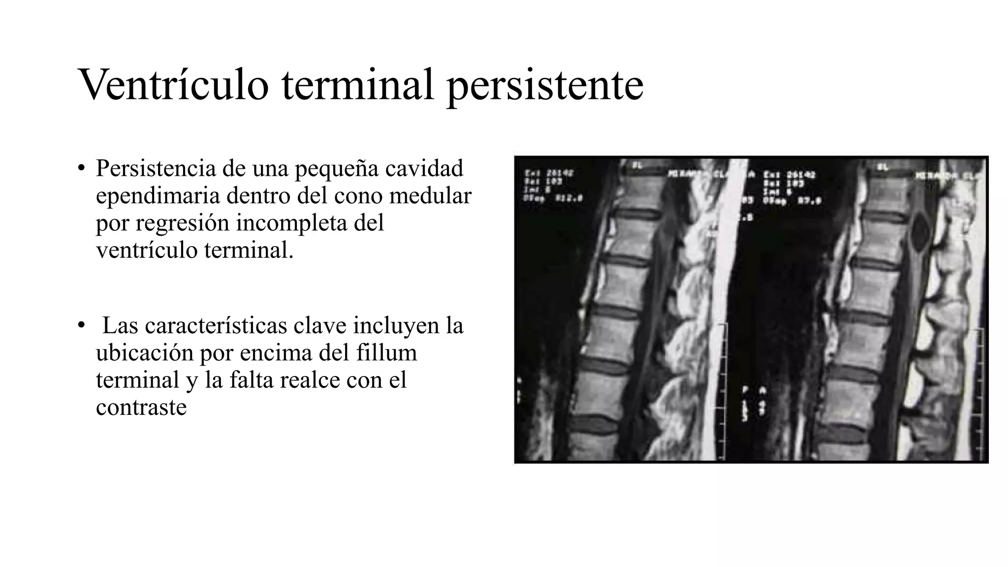 Disrafismos espinal abierto y oculto | PPTX