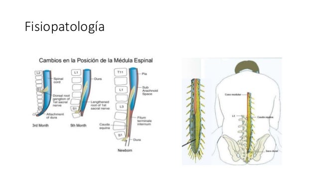 Disrafismos espinal abierto y oculto