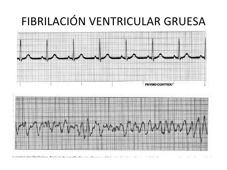 Fibrilacion Ventricular Fina Y Gruesa Latina ECG 7.8 Arritmias