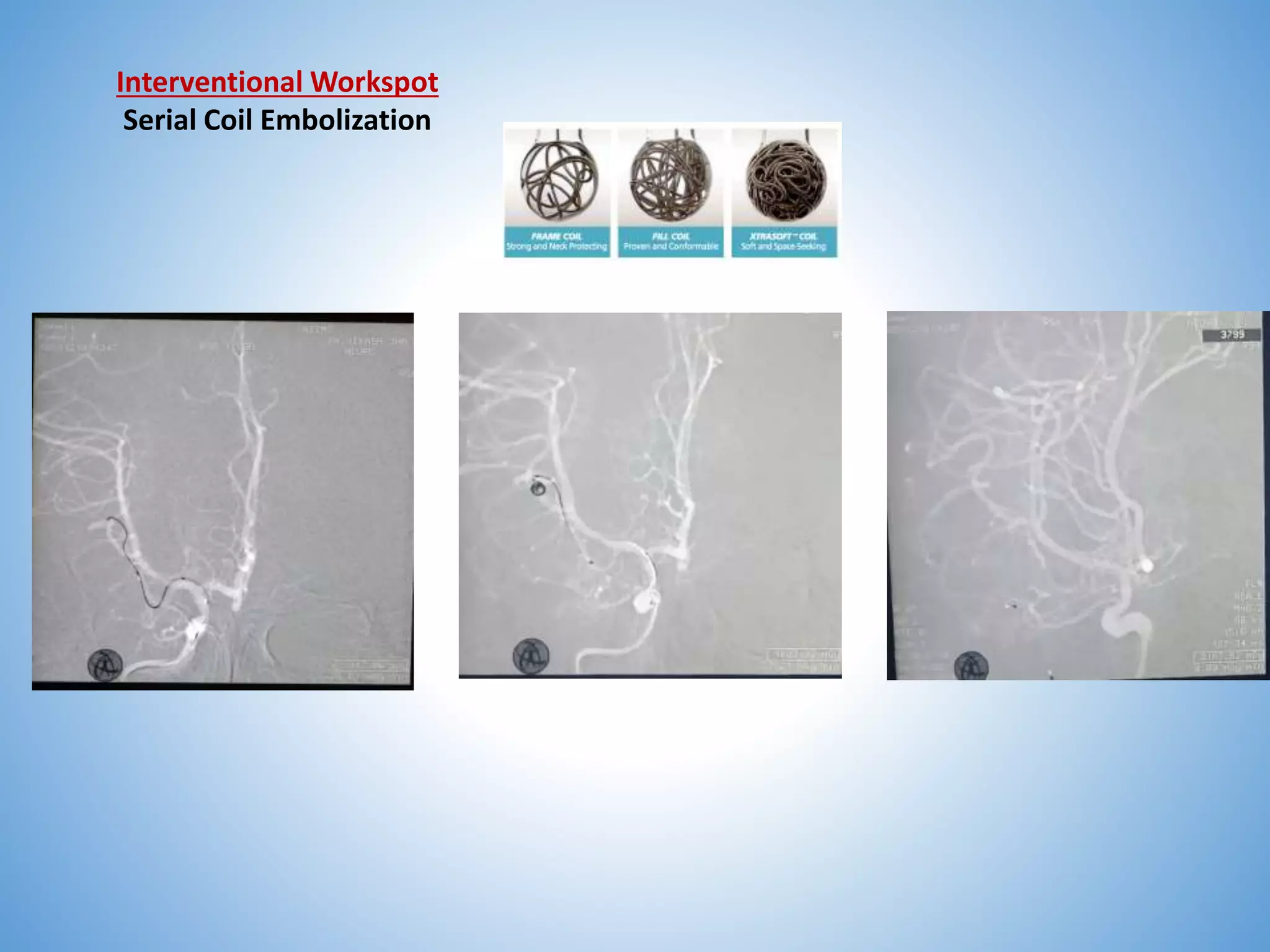Endovascular Coil Embolization of Dissecting distal MCA Aneurysm with ...